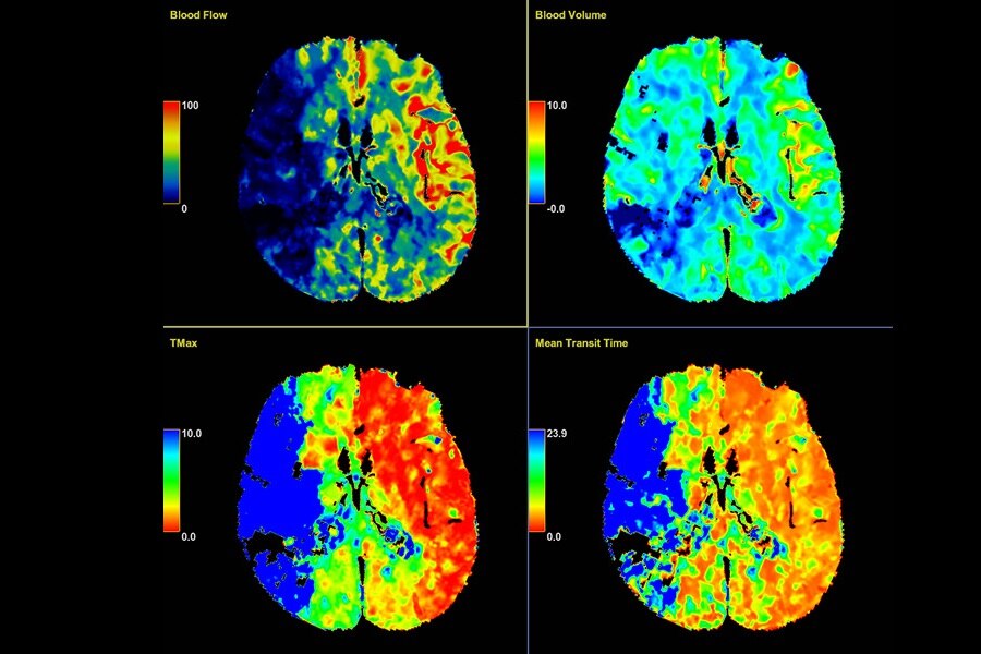 CT Perfusion 4D Neuro | GE Healthcare