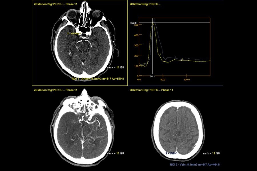 CT Perfusion 4D Neuro | GE Healthcare