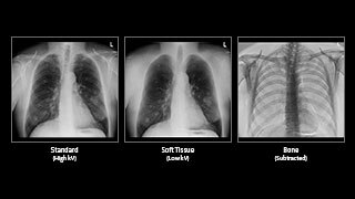 Двухэнергетическое субтракционное изображение | GE HealthCare (Russia)
